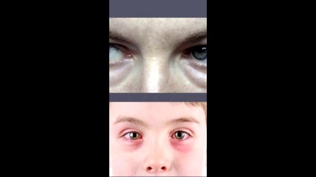 Как узнать. Признаки болезни по глазам.