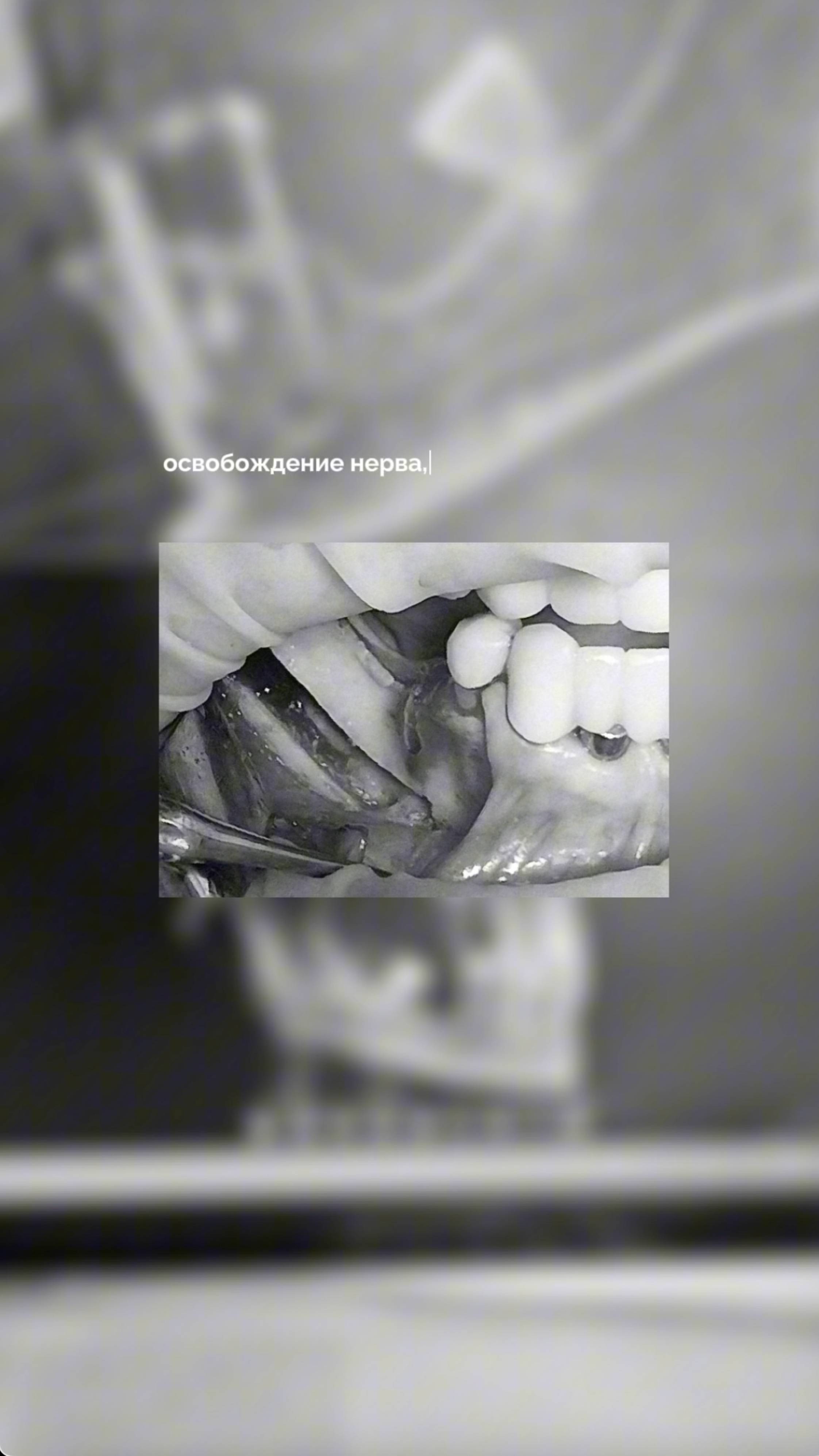 Перемещение нерва вместо наращивания кости #shots