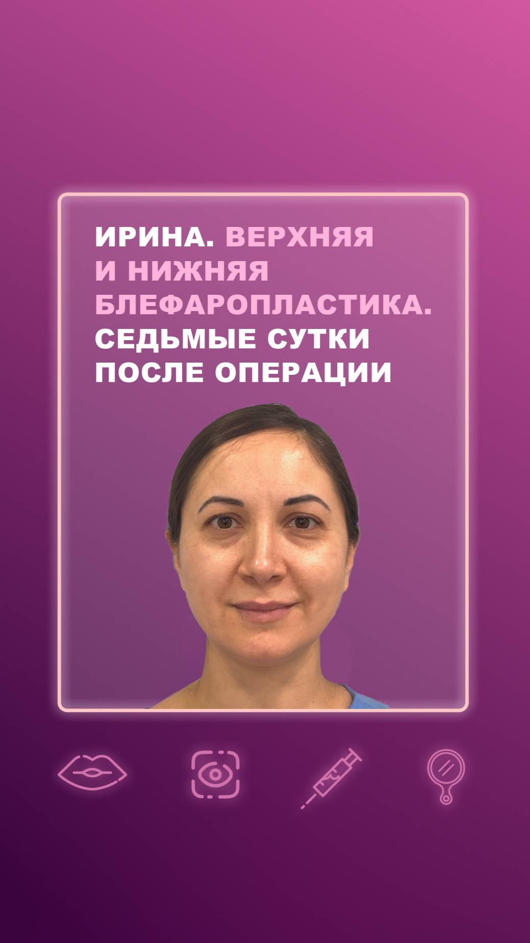 Ирина. Верхняя и нижняя блефаропластика. Седьмые сутки после операции