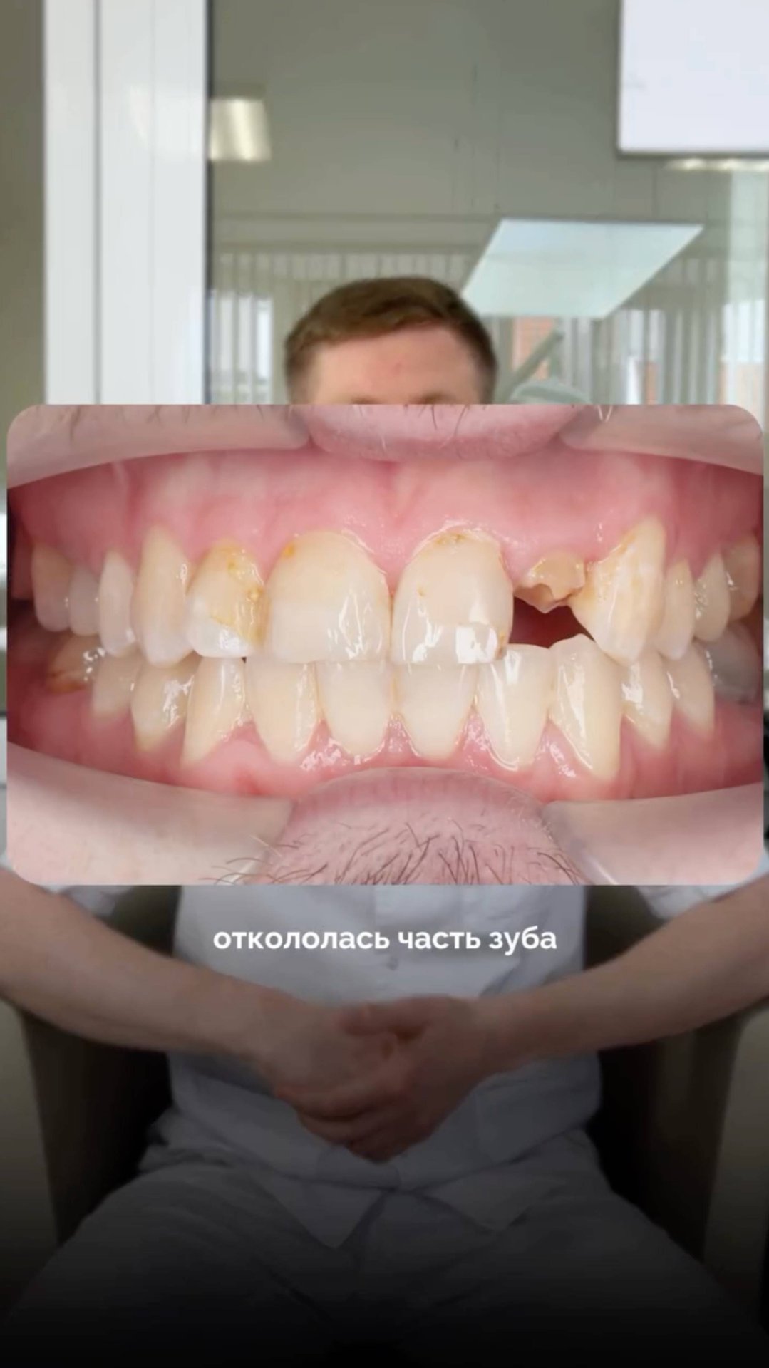 Откололась часть зуба - что делать? #shots