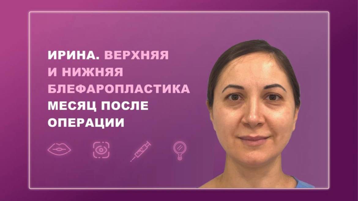 Ирина. Верхняя и нижняя блефаропластика. Месяц после операции