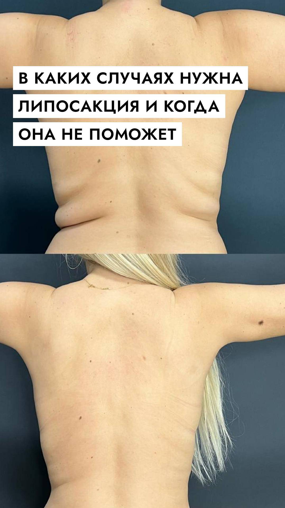 #липосакция: в каких случаях не поможет?