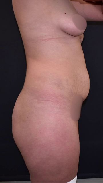 Mommy makeover в исполнении пластического хирурга Парыгина Егора Андреевича😍