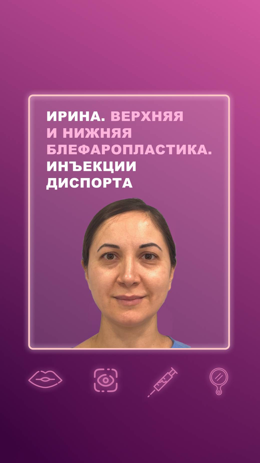 Ирина. Верхняя и нижняя блефаропластика. Инъекции Диспорта