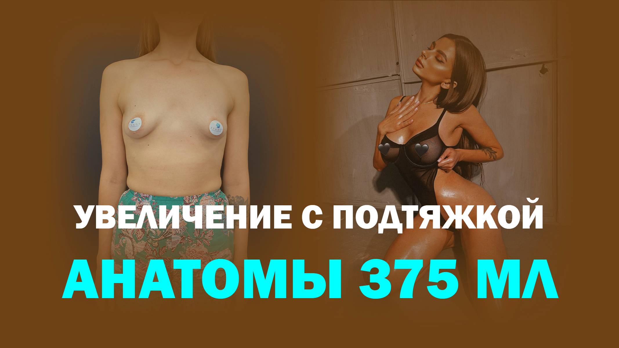 Преображение груди у доктора Мустафаева: до и после