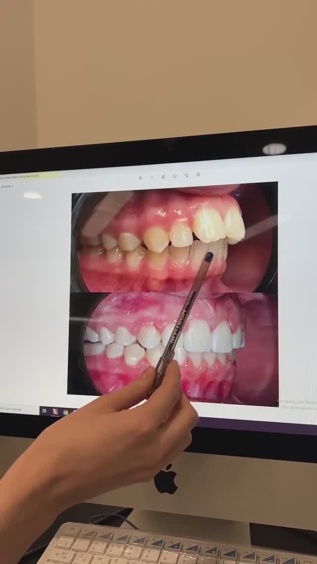 Ортодонтическое лечение. Клинический случай