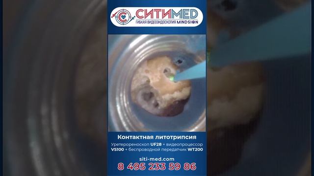 Контактная литотрипсия (уретерореноскоп UF28 + видеопроцессор VS100, беспроводное подключение)