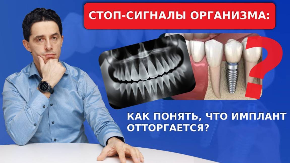 Топ-7 главных вопросов о приживлении имплантов