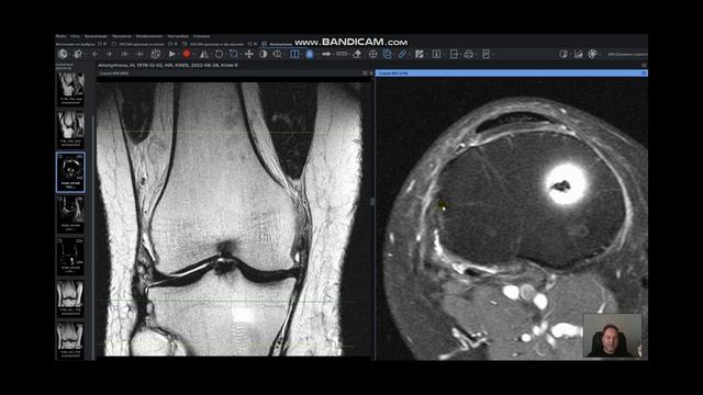 В продолжение темы повреждение коленного сустава...