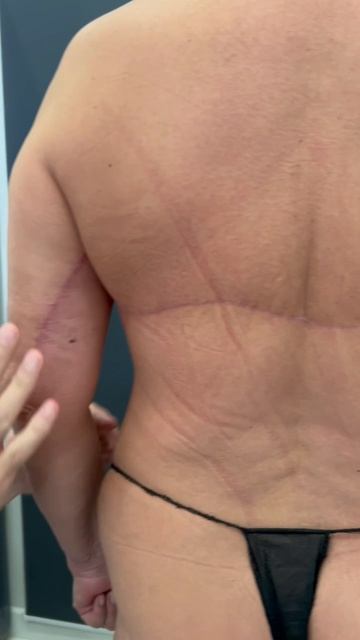 #липосакция живота: очередной шаг к преображению