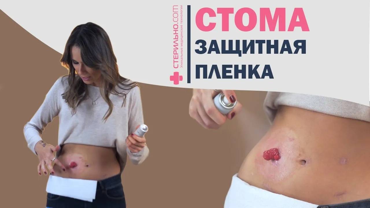 Зачем нужна защитная пленка для стомы?  | Стерильно.com 4К