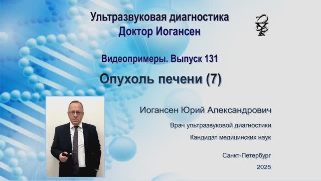 УЗИ. Доктор Иогансен. Видеопримеры. Выпуск 131. Опухоль печени (7).