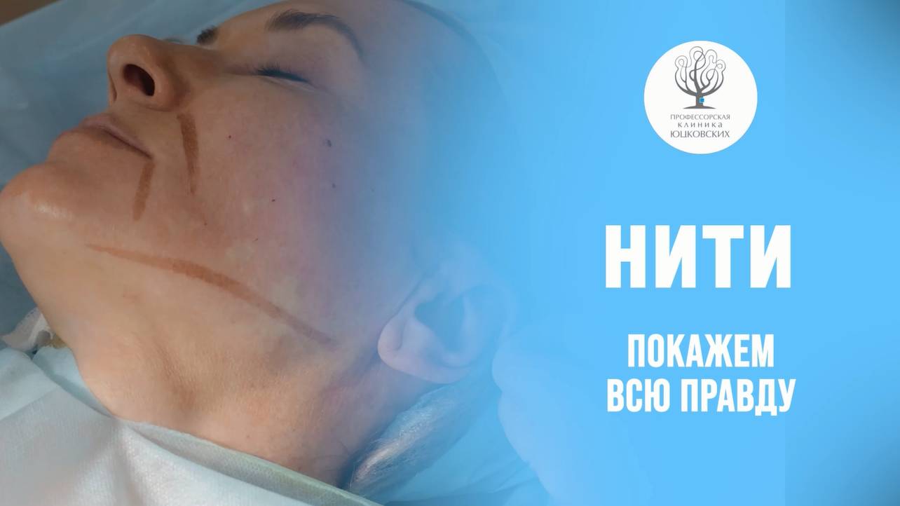 Нитевой лифтинг: лицо ДО и ПОСЛЕ ✨ Пациент в шоке от эффекта!  #лифтинг #омоложение #нити