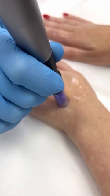 Мезотерапия нужна не только коже лица ✨