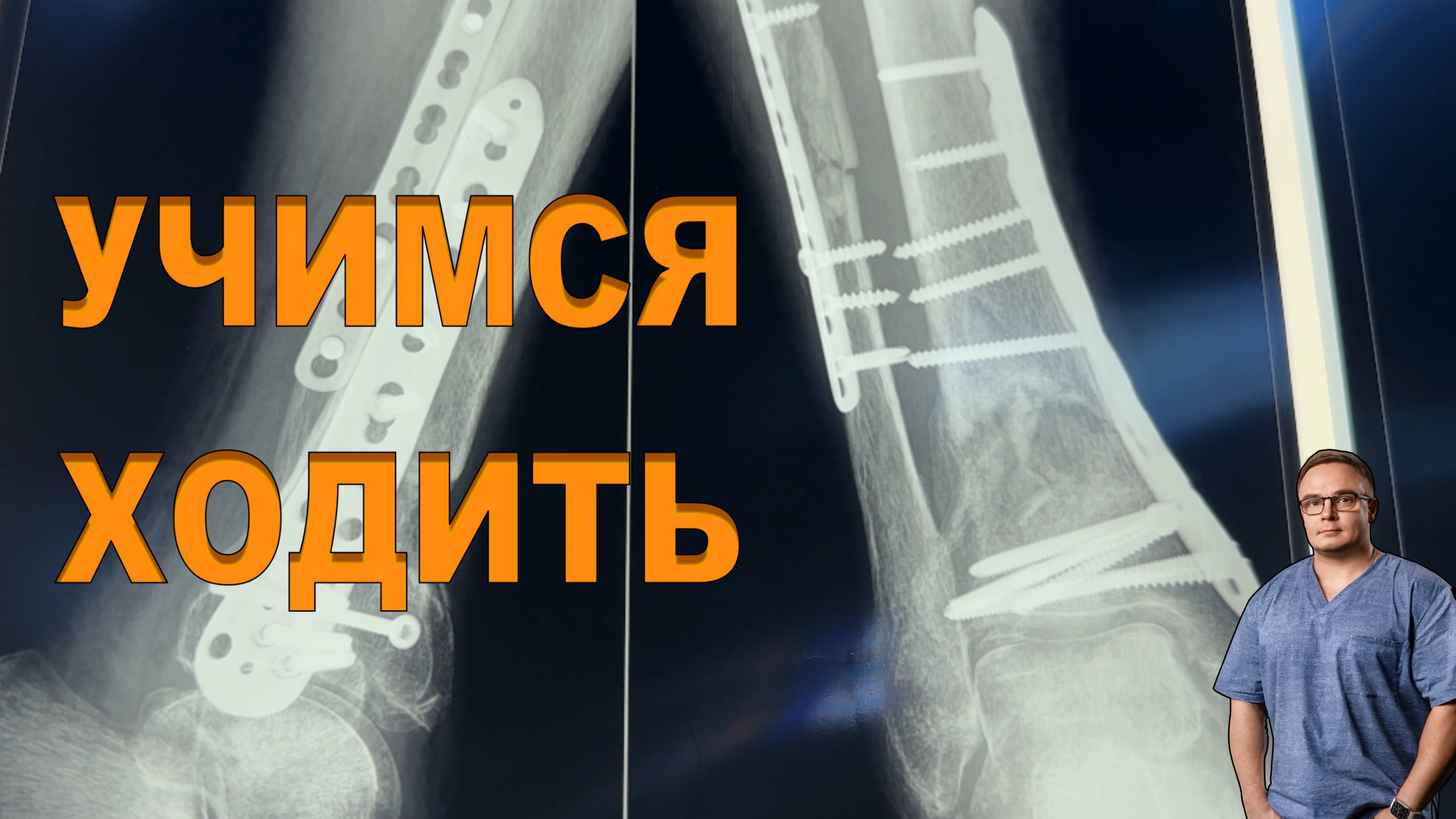 УЧИМСЯ ХОДИТЬ ЧЕРЕЗ 3 МЕСЯЦА ПОСЛЕ ОПЕРАЦИИ | Перелом Голени