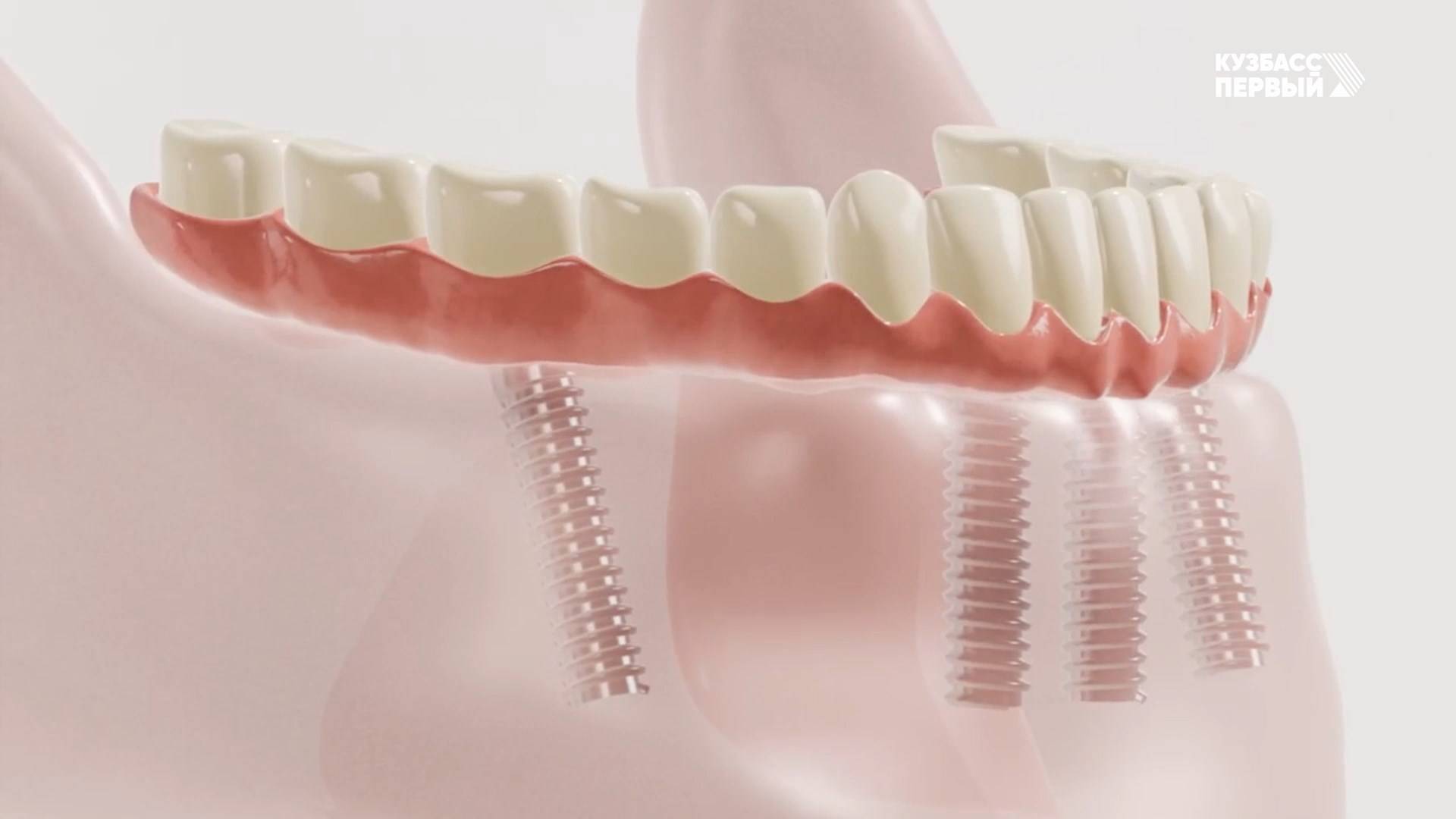 Здоровая улыбка России. Коронки или импланты, и можно ли определить, как часто чистят зубы?