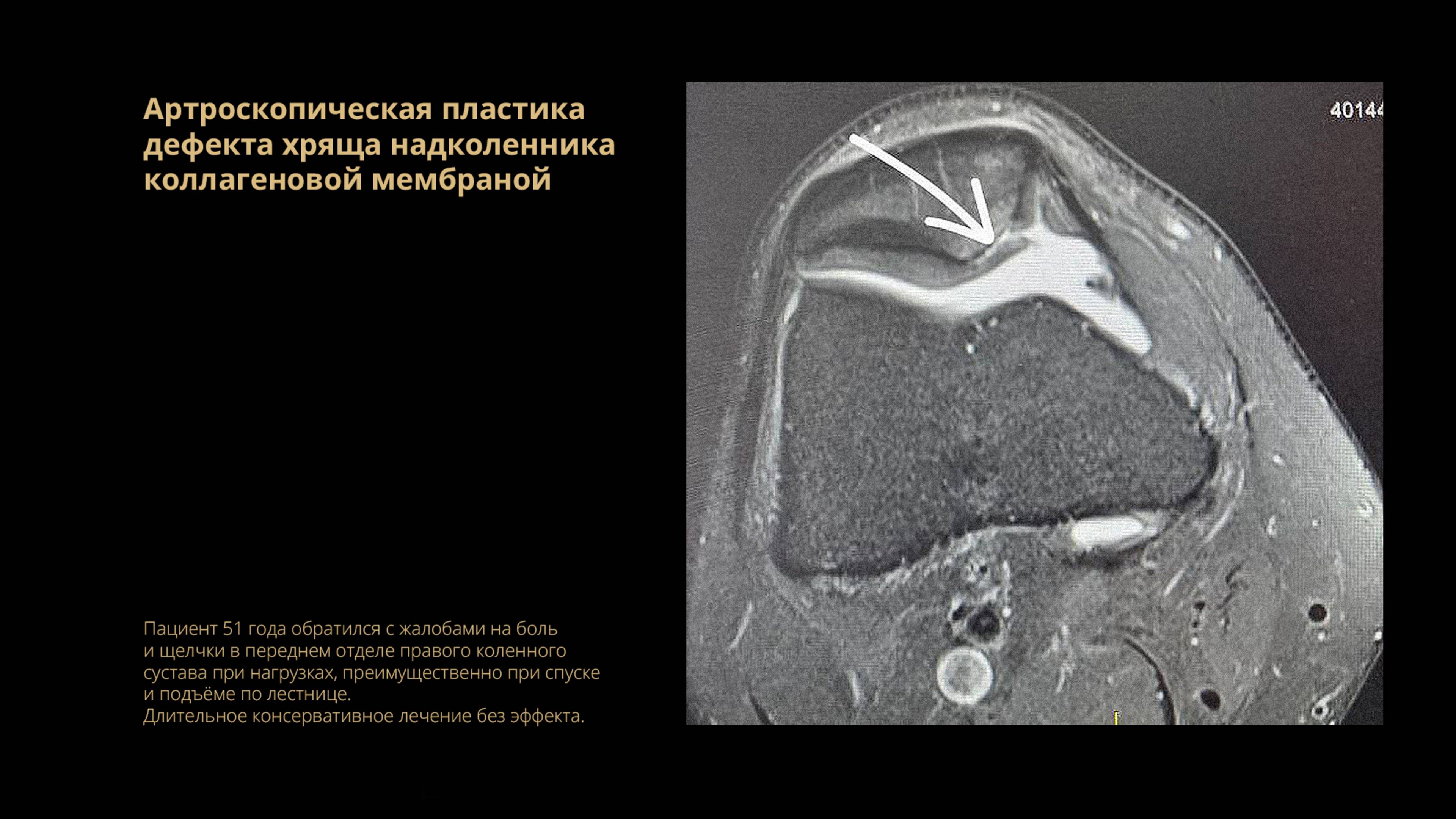 Артроскопическая пластика дефекта хряща надколенника коллагеновой мембраной