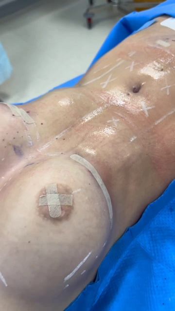 #липоскульптура и #увеличение_груди: сразу после операции