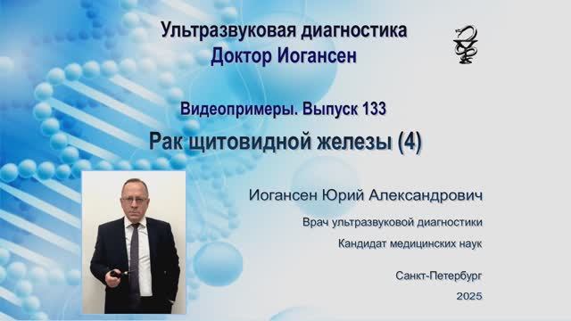 Ультразвуковая диагностика. Доктор Иогансен. Видеопримеры. Выпуск 133. Рак щитовидной железы (4).