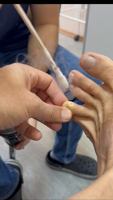 Лечение стержневой мозоли жидким азотом..