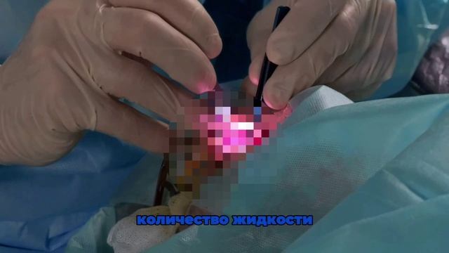 Трансклеральная лазерная коагуляция цилиарного тела (при глаукоме)