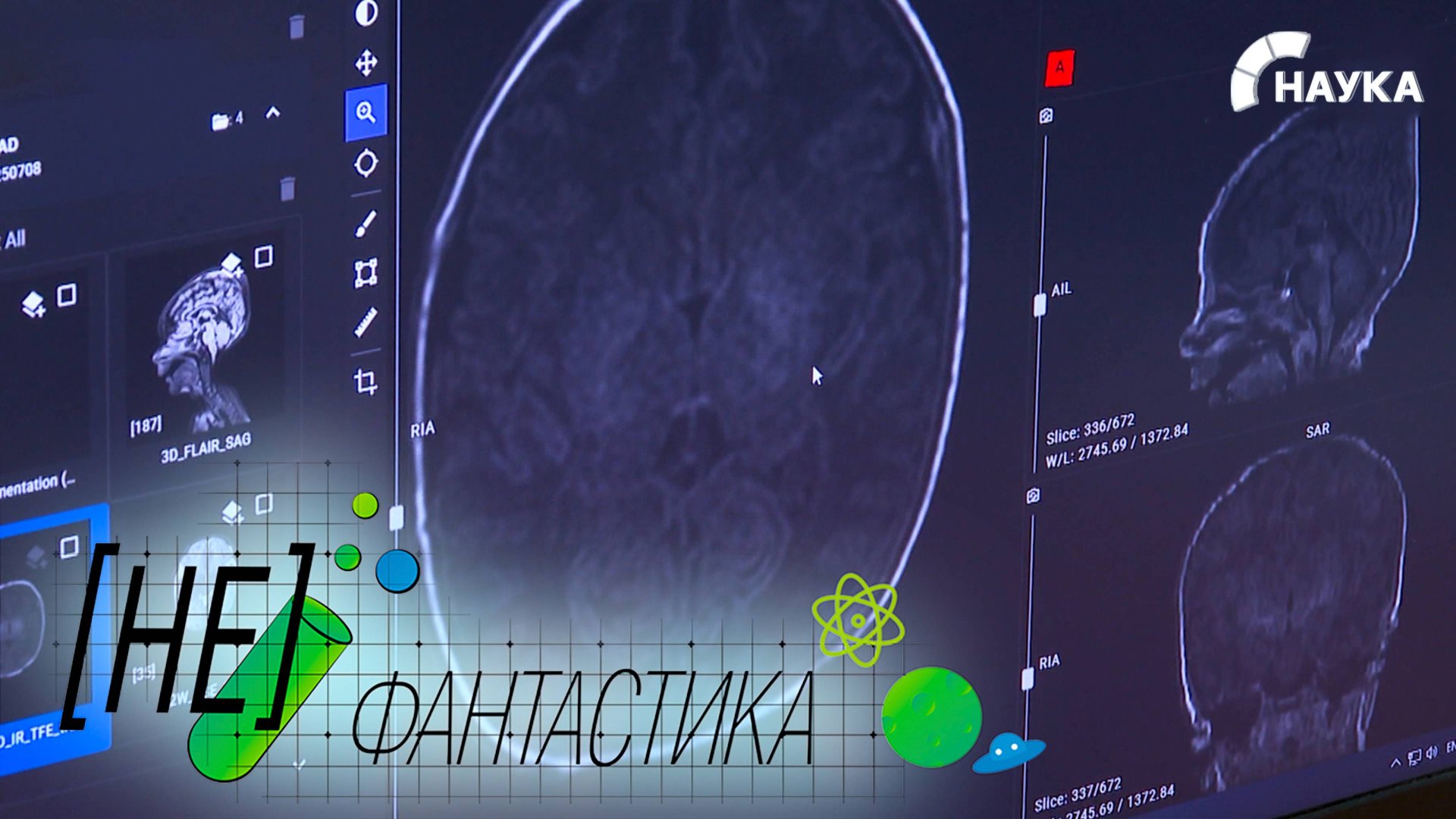 Нейро-доктор: как ИИ помогает врачам выявлять первые признаки ДЦП и других болезней нервной системы