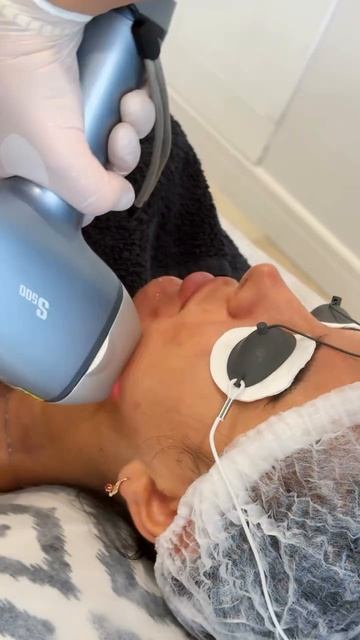 Лазерное омоложение лица на аппарате Super Touch 500