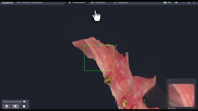 Сканирование слизистой нижней челюсти