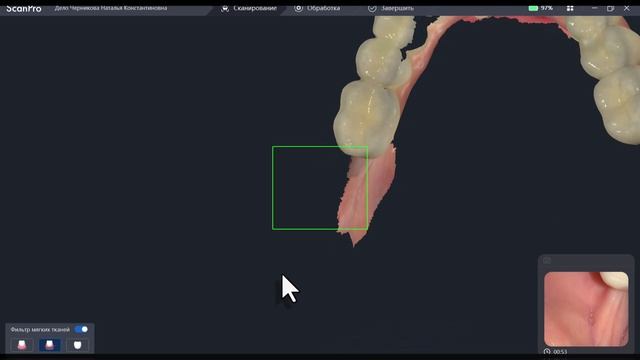Сканирование готовой  конструкции на нижней челюсти