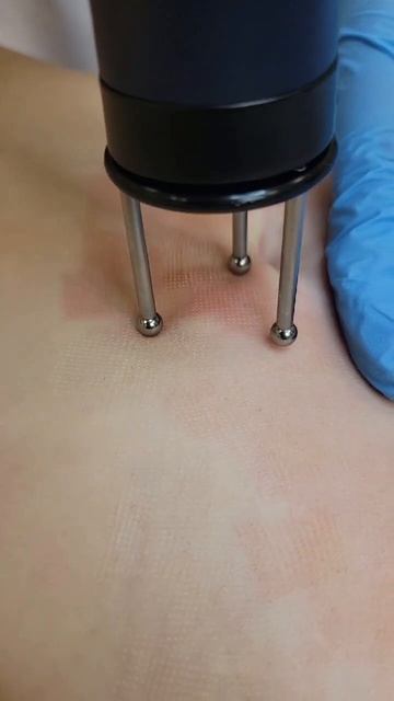 MCL 31 DERMABALTE  - РАСТЯЖКИ