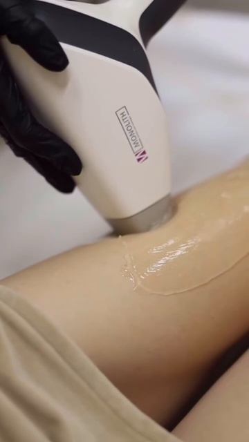 Лазерная эпиляция на MedioStar Monilith