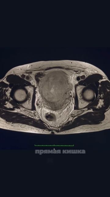 Огромная опухоль матки на снимках МРТ