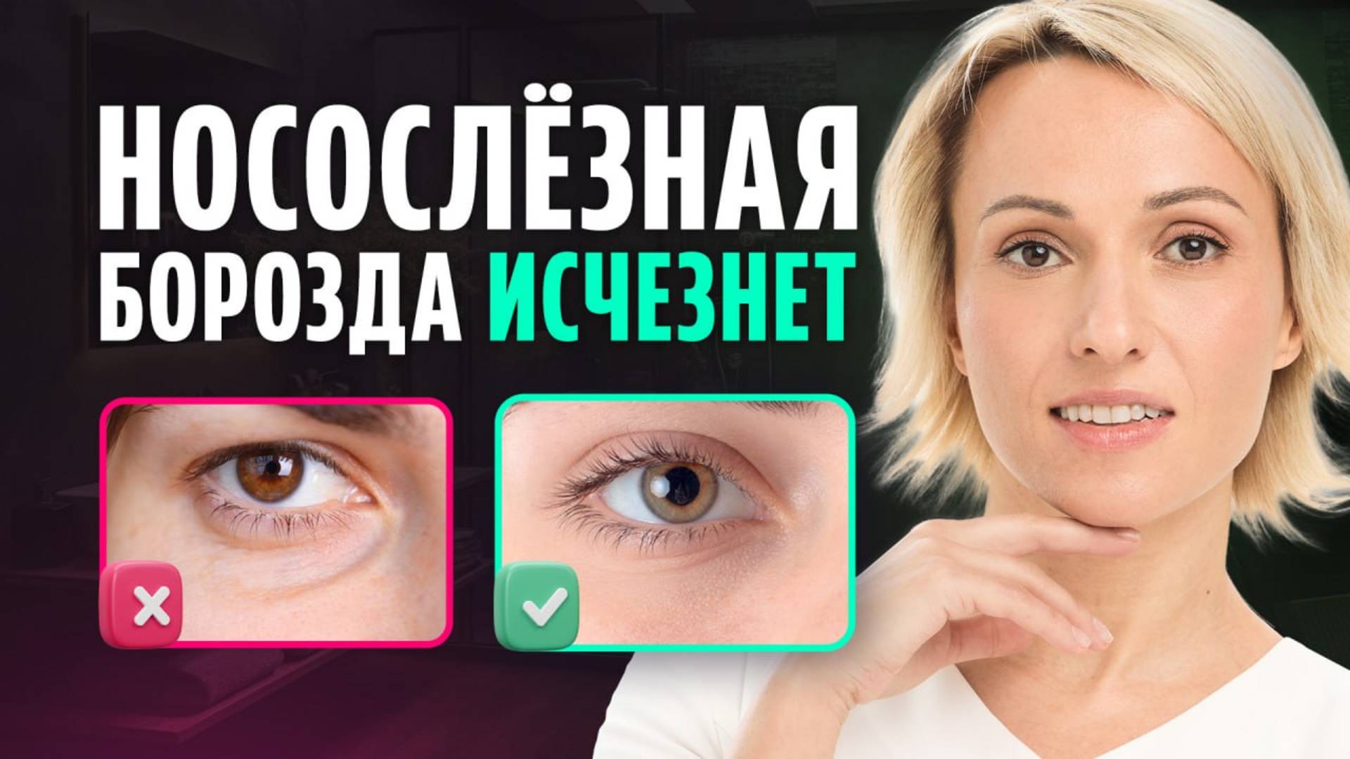 После ЭТИХ приемов НОСОСЛЕЗНАЯ БОРОЗДА исчезнет / Как убрать впадины под глазами без ФИЛЛЕРОВ