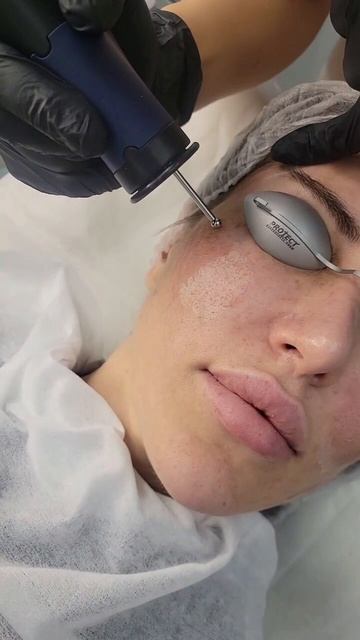 Эрбиевый лазер Dermablate