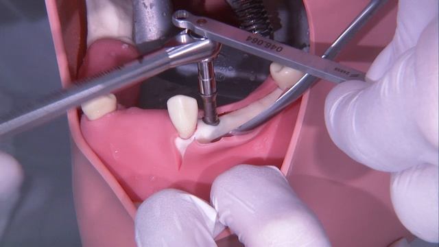 Упражнения на имплантах  (14 часть)