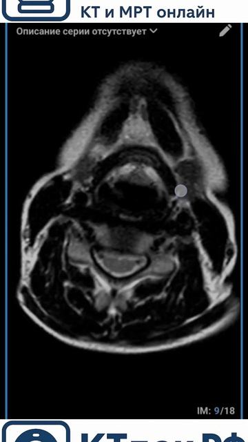Периневральные кисты
