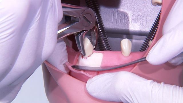 Немедленная имплантация (3 часть, добыча)