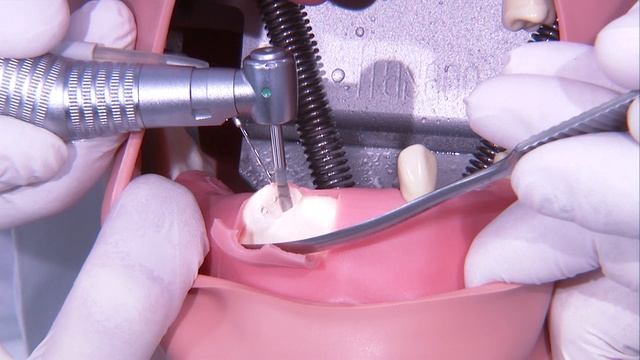 Немедленная имплантация (5 часть, пилотный участок 1)