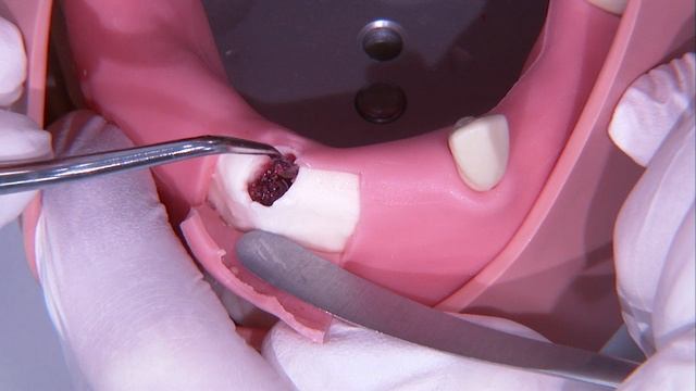 Немедленная имплантация (11 часть, подготовка и установка материала для наращивания кости)