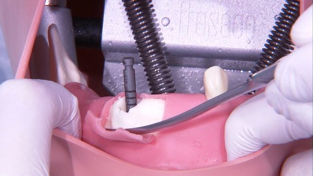 Немедленная имплантация (8 часть, измерение глубины)