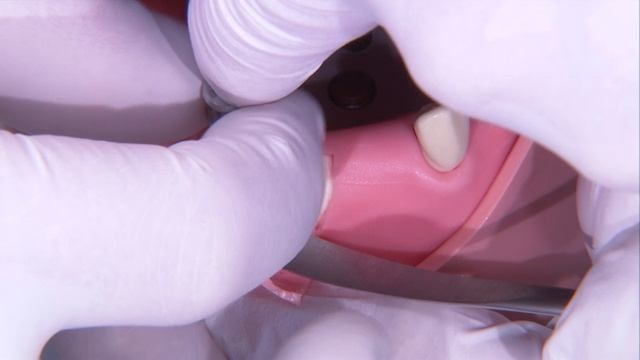 Немедленная имплантация (10 часть, вставка винта закрытия)