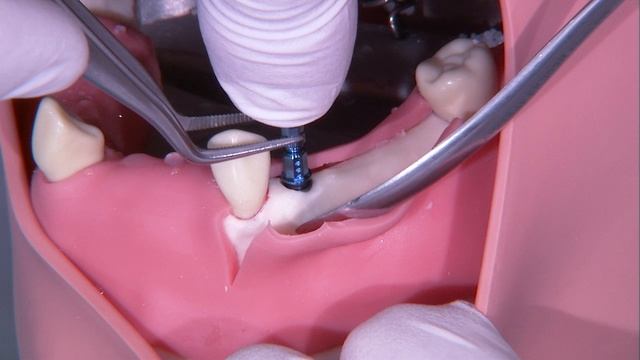 Упражнения на имплантах (17 часть, вставка держателя импланта)