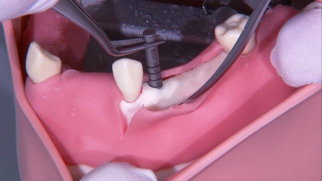 Упражнения на имплантах (10 часть, измерение глубины)