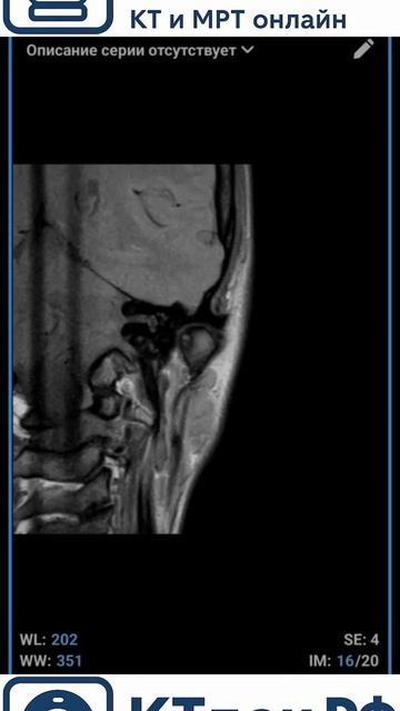 Височно-нижнечелюстной сустав