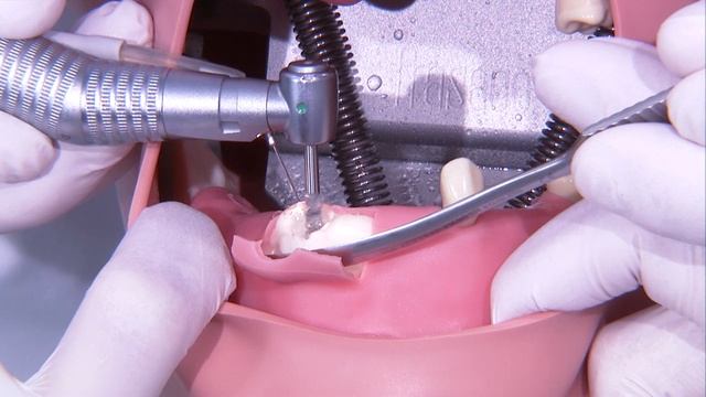 Немедленная имплантация (6 часть, пилотная площадка 2) Симуляция.