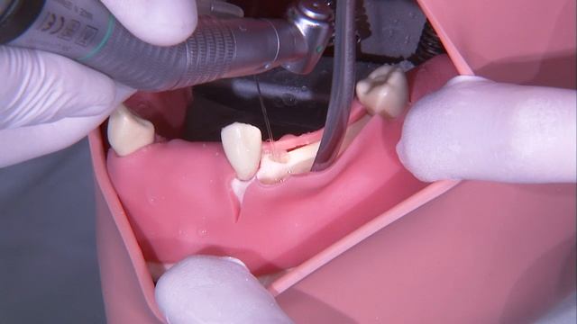 Упражнения на имплантах  (15 часть, промывание места имплантации)