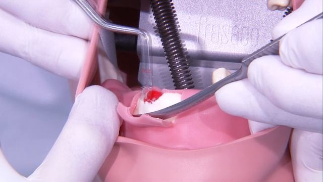 Немедленная имплантация (4 часть. чистка альвеол)