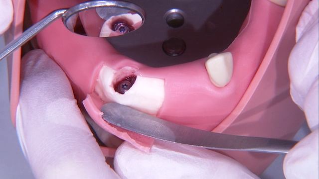 Немедленная имплантация (12 часть, зеркальный обзор операционного сектора)