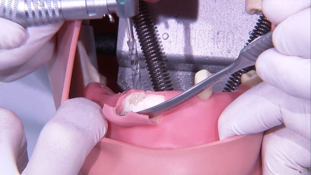 Немедленная имплантация (7 часть, подготовка площадки спиральным сверлом)