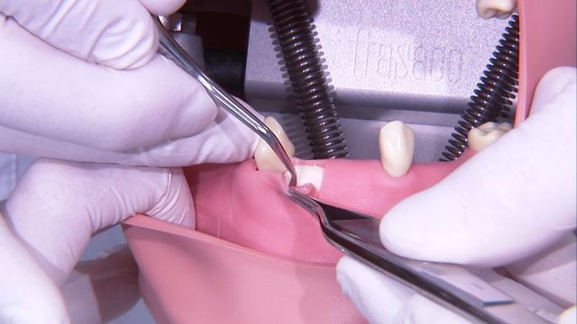 Немедленная имплантация (2 часть, поднятие клапана)